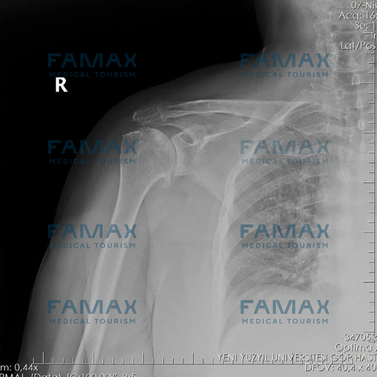 Success: Shoulder joint prosthesis surgery saved patient from years of ...