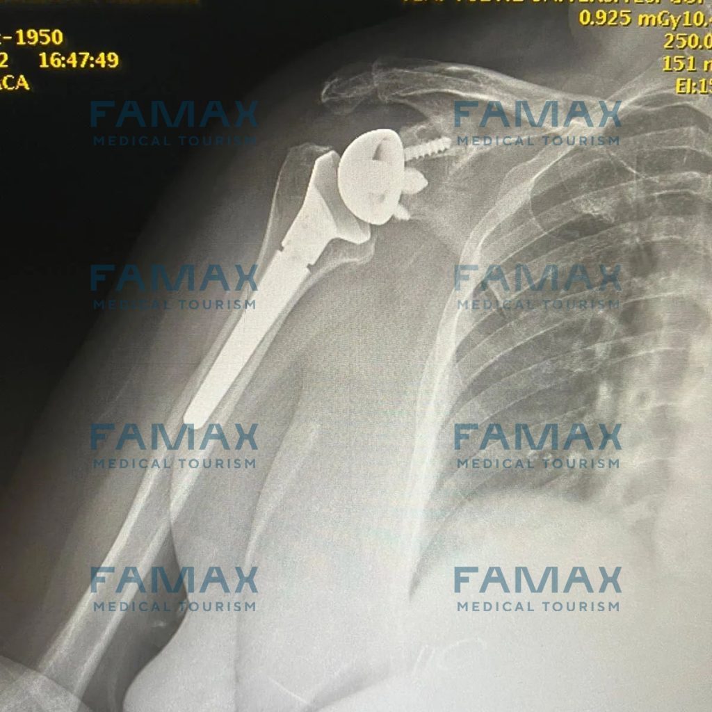 Success: Shoulder joint prosthesis surgery saved patient from years of ...